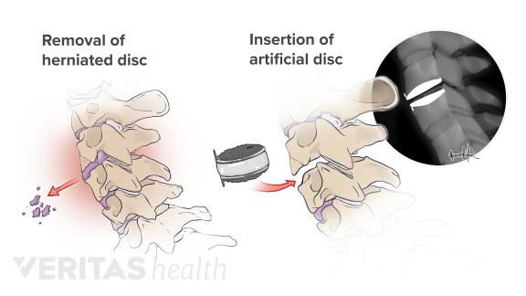 Know About Cervical Artificial Disc Replacement Surgery – New Bombay ...